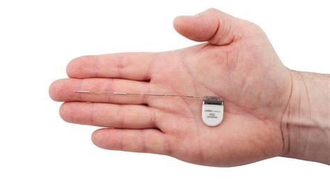 Implantable Sensor For Real Time Monitoring Of Epilepsy Ictandhealth