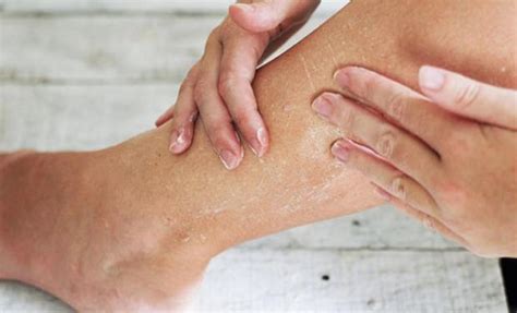 Экзема На Ногах Фото —