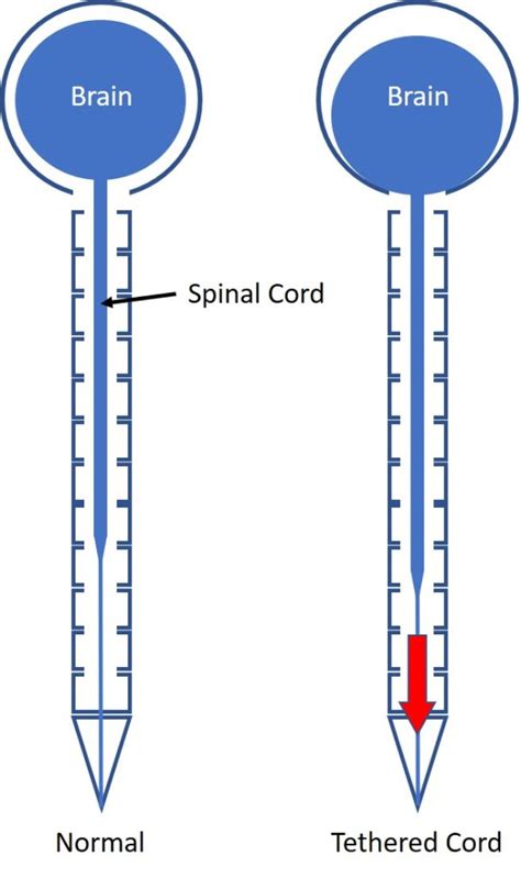 Surgery For Tethered Cord In Adults Regenexx