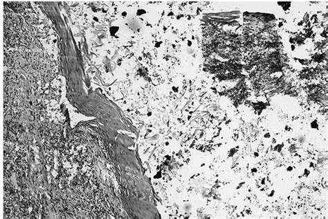 Cyst Wall Lined By Keratinising Stratified Squamous Epithelium