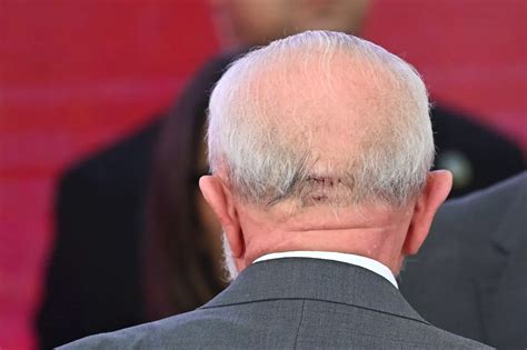 O que é craniotomia para drenagem de hematoma procedimento ao qual