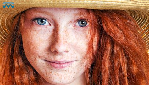 Las Pecas Por Qué Salen Las Pecas Y Cómo Eliminarlas
