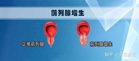 什么是前列腺增生肥大 知乎