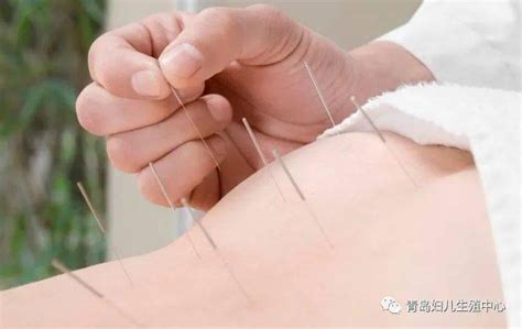 助孕之路，针灸相助东方养生频道东方养生