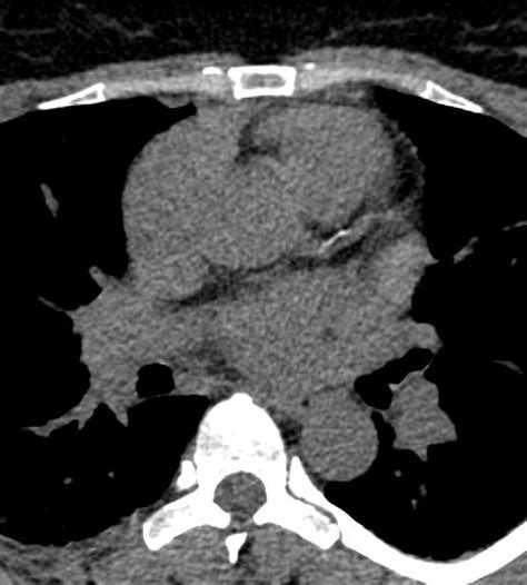 153lu Myopathy Arthritis And Possible Scleroderma Overlap Fibrotic Nsip