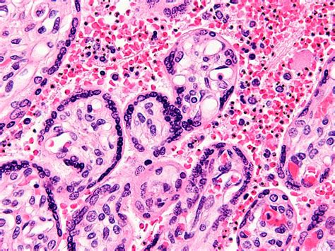 The Evolving Placenta Pregnancy Associated Malaria Research Suggests A