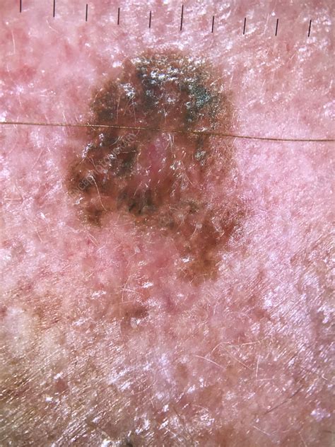 Melanoma In Situ Dermoscopy Stock Image C0562557 Science Photo