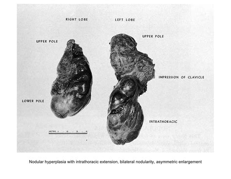 Pathology Outlines Thyroid Follicular Nodular Disease Multinodular Goiter