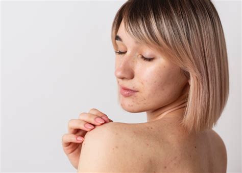 Acne Scars Poms Med Spa