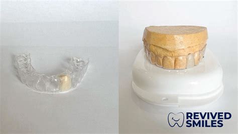 Essix Partial Denture Retainers Everything You Must Know