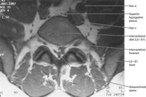 Superior Hypogastric Plexus Block Clinical Gate