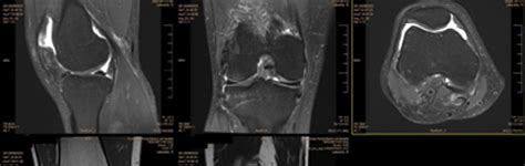 Resonancia Magnética De Rodilla Zona Hospitalaria