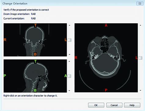 Dicom Data Converted By Mimics Software T Top B Bottom A