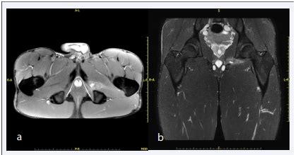 A Case Of Ischial Bursitis Occurring In Obturator Externus Muscle