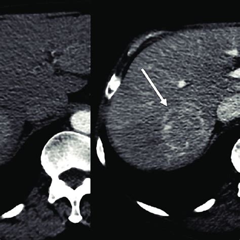 Enhanced Ct Arterial And Portal Phase A Large Hepatic Nodule 5 Cm