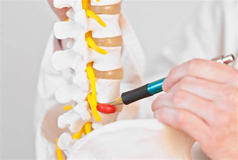 How To Heal A Herniated Disc Without Surgery