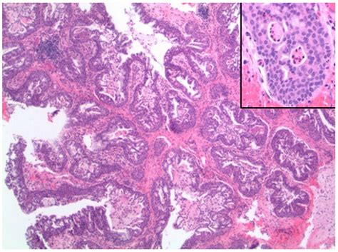 Inverted Papilloma Of The Middle Ear And Mastoid Cavity A Case Report