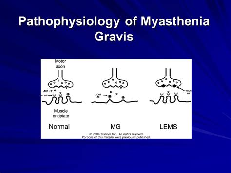 Myasthenia Gravis And Antibiotics Use