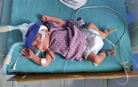 Improving Newborn And Pediatric Quality Of Care By Strengthening Access To Safe Use Of Oxygen