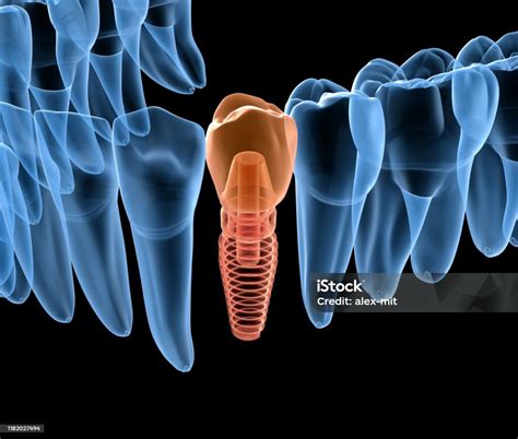 임플란트 엑스레이 보기로 조발치 치아 회복 인간의 치아와 의치 개념의 의학적으로 정확한 3d 그림 건강관리와 의술에 대한 스톡 사진 및 기타 이미지 Istock