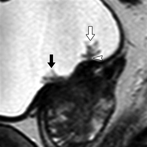 Inverted Papilloma Bladder