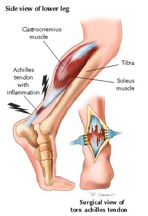 Achilles Rupture Physiopedia