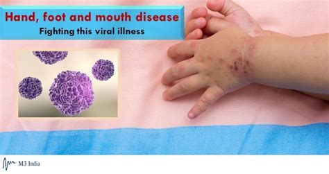 Increasing Cases Of Hand Foot And Mouth Disease How To Diagnose And T