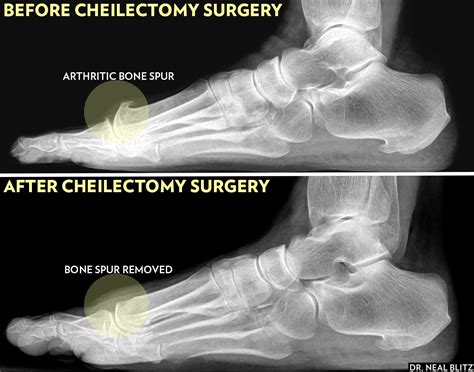 Hallux Rigidus Cheilectomy