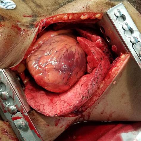 Open Thoracotomy R Medizzy