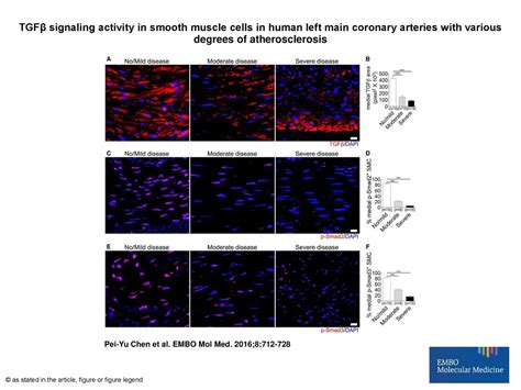 Tgfβ Signaling Activity In Smooth Muscle Cells In Human Left Main