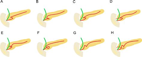 Ansa Pancreatica Type Of Ductal Anatomy Pacs