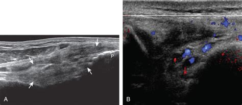 Elbow Ultrasound Radiology Key