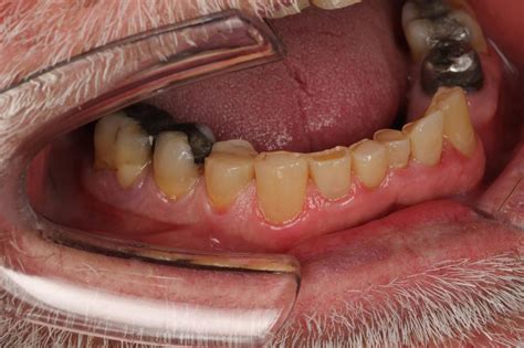 Increase Cuspal Restoration Options With One Visit Crown Uk