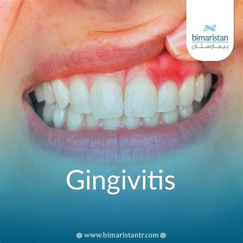 Gingivitis Everything You Need To Know About Treating Inflamed Gums