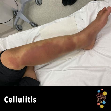 Cellulitis Leg