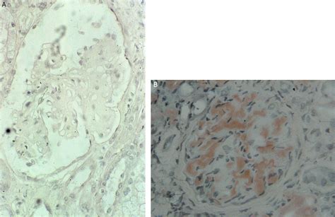 JLE Néphrologie Thérapeutique Amylose systémique diagnostic en