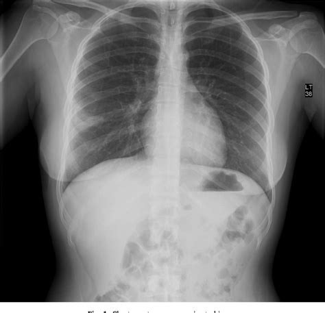 Figure 1 From A Case Of Echinococcal Cyst Of The Lung Semantic Scholar