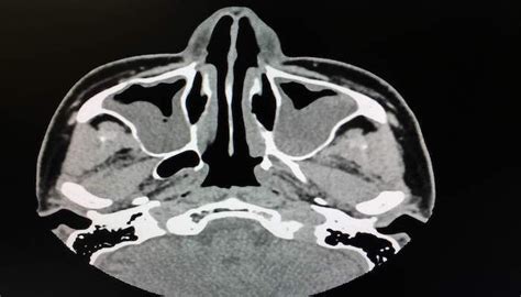 Nasal Polyps Removal Surgery Backtable Ent