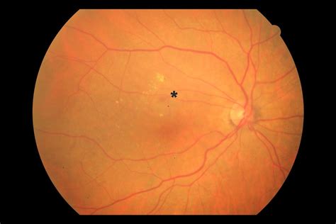 Extramacular Choroidal Neovascular Membrane