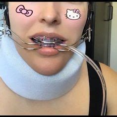 Orthodontic Headgear Braces Ideas Headgear Braces Girls Braces