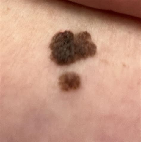Mole That Formed During Pregnancy Rmelanoma