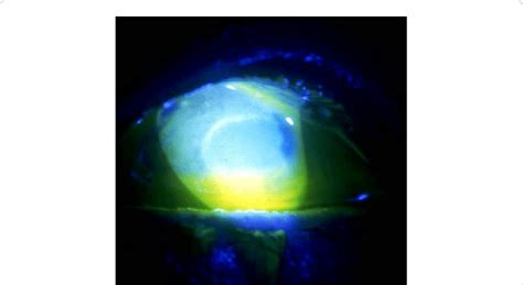 B Same Case Of A Stained With Fluorescein Showing Non Healing Corneal