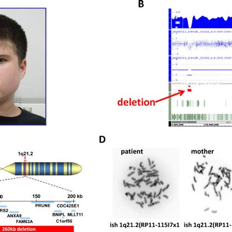 A Diagram Of Complex Chromosomal Rearrangements In The 22q13 Download Scientific Diagram