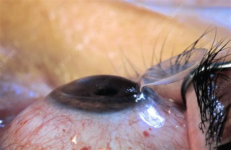 Laser Eye Surgery Stock Image C0021977 Science Photo Library