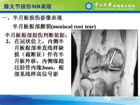 膝关节半月板和韧带损伤的影像学诊断 好医术早读文章 好医术 赋能医生守护生命