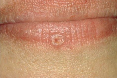 Keratocanthoma Medizzy