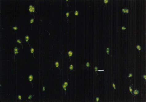 187短膜虫间接免疫荧光法阳性iif Cl 内分泌 医学