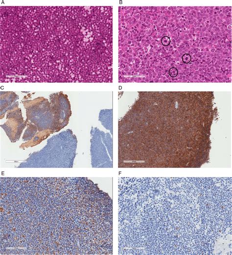 Smear Preparation And Frozen Demonstrated Small Blue Cell Tumor