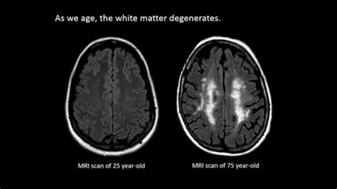 What Is White Matter Disease Healthtian
