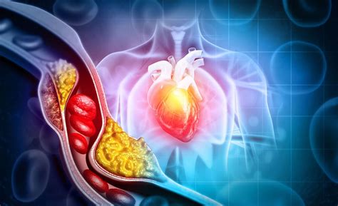 Oxidized Ldl Oxldl The Risk Factor You Need To Know